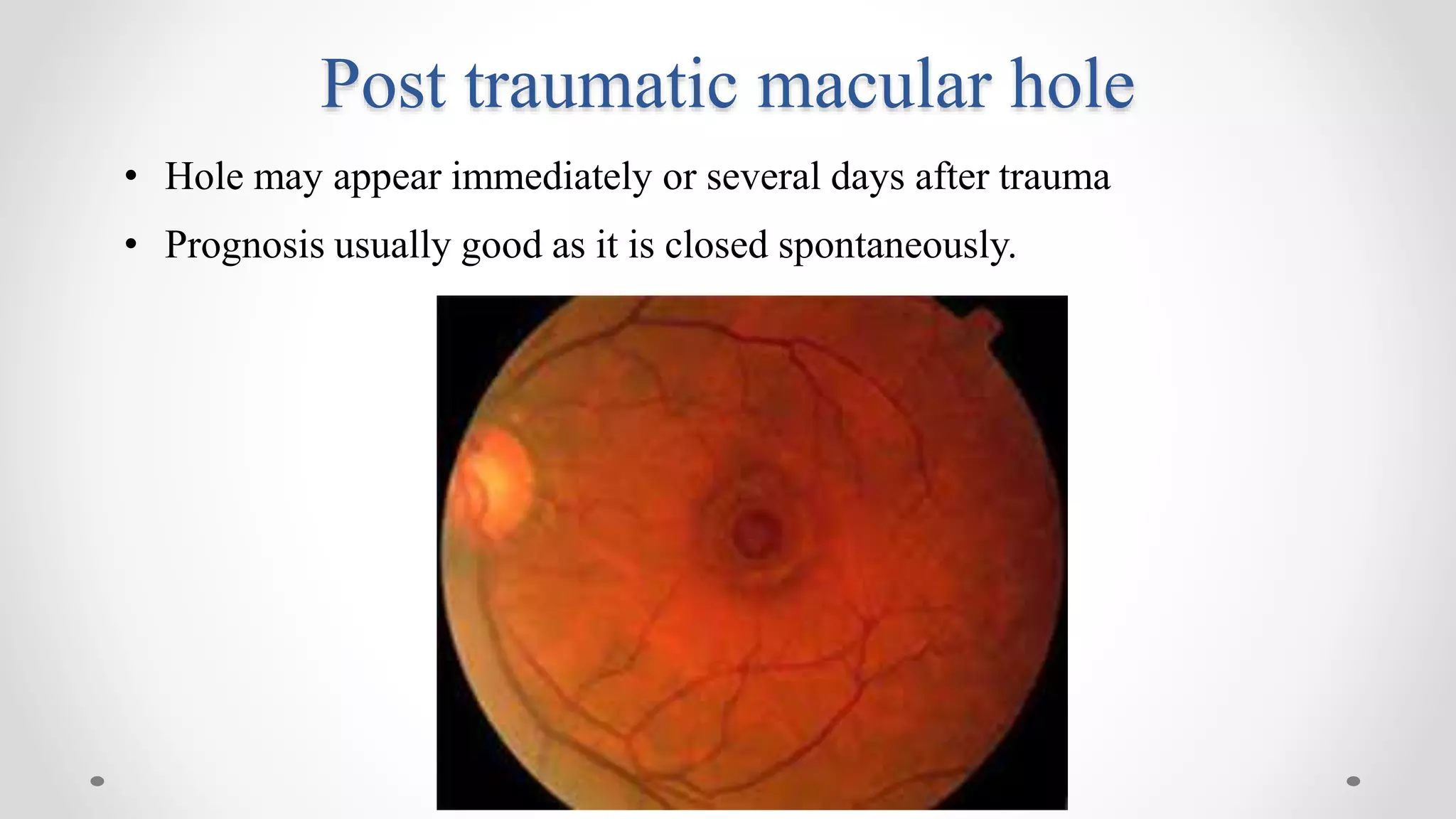 Posterior segment manifestations of blunt trauma-1.pptx