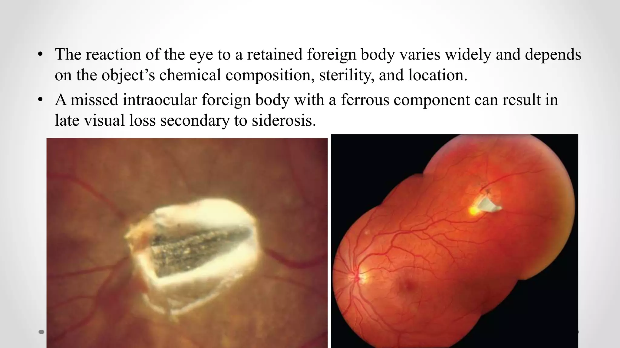 Posterior segment manifestations of blunt trauma-1.pptx