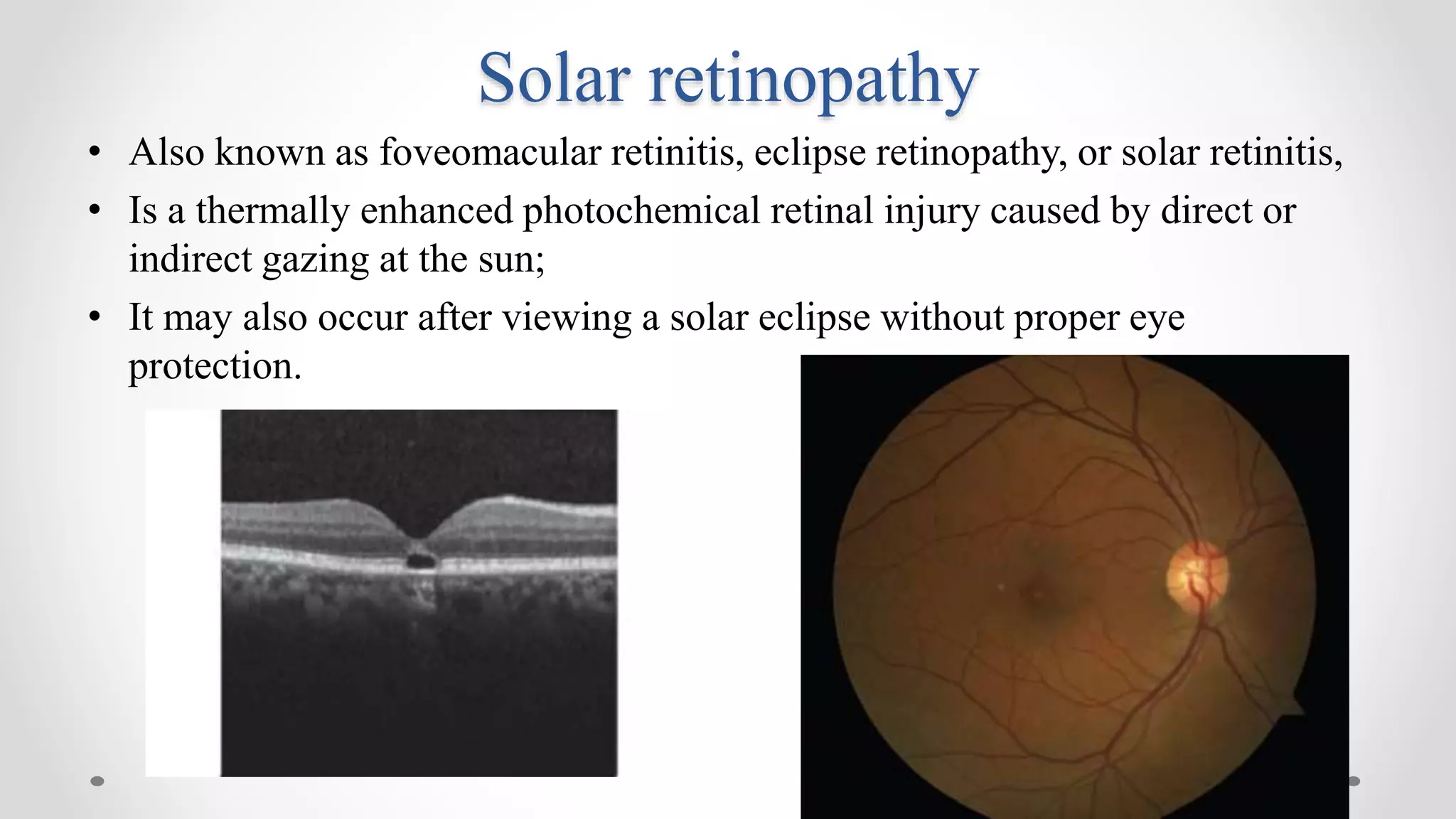 Posterior segment manifestations of blunt trauma-1.pptx