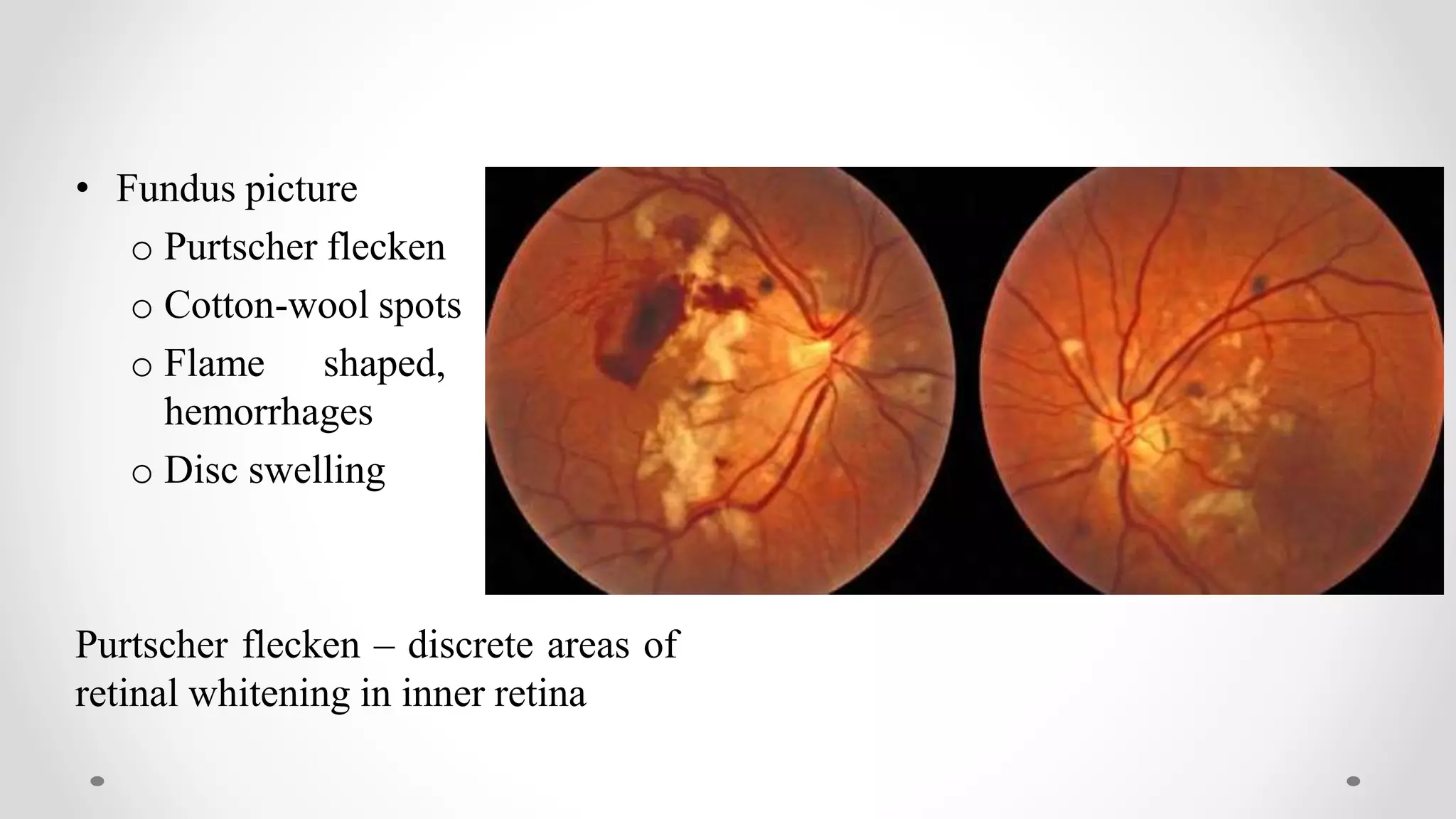 Posterior segment manifestations of blunt trauma-1.pptx