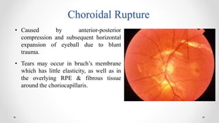Posterior segment manifestations of blunt trauma-1.pptx