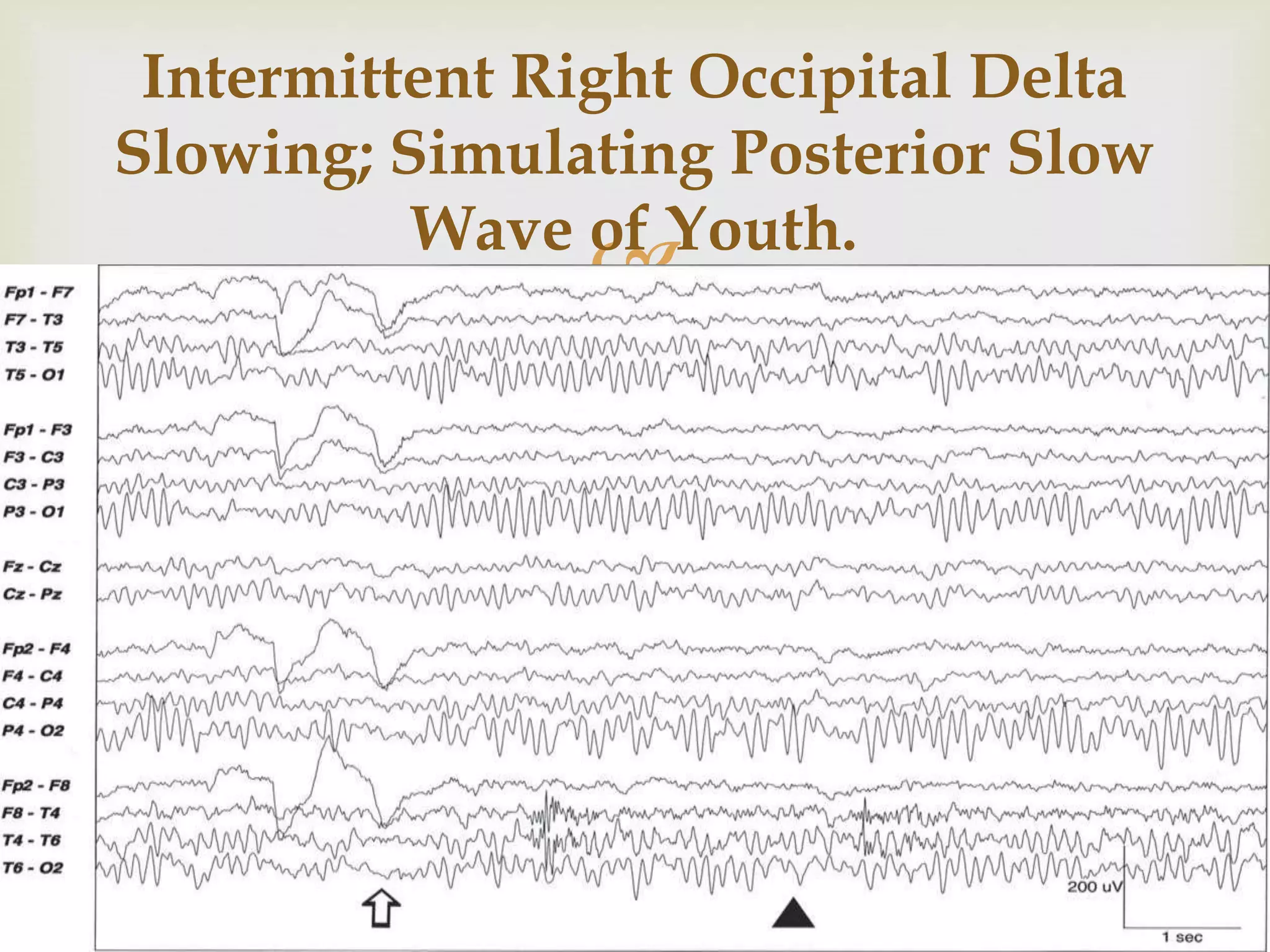 Posterior slow waves of youth | PPTX