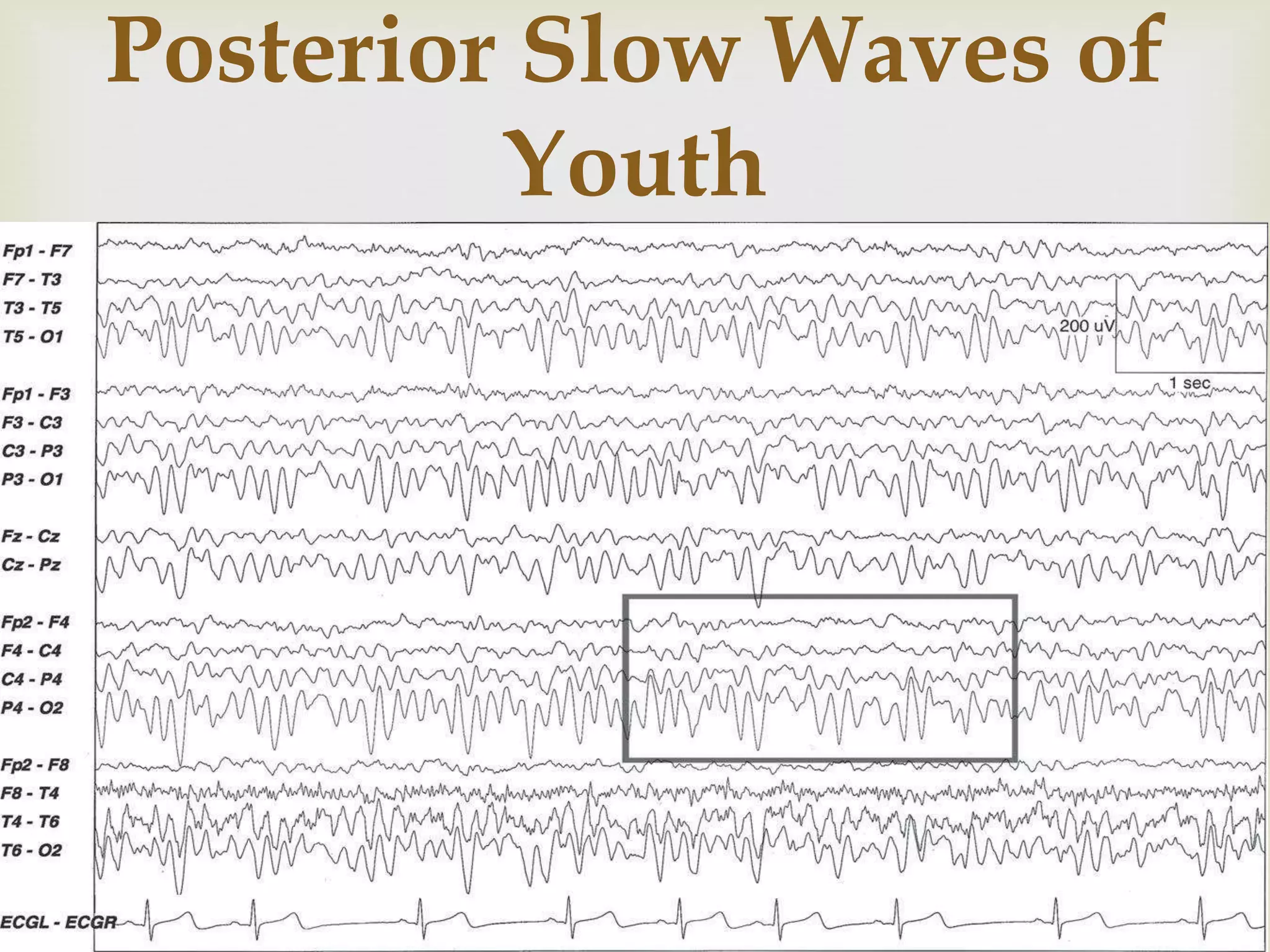 Posterior slow waves of youth | PPTX