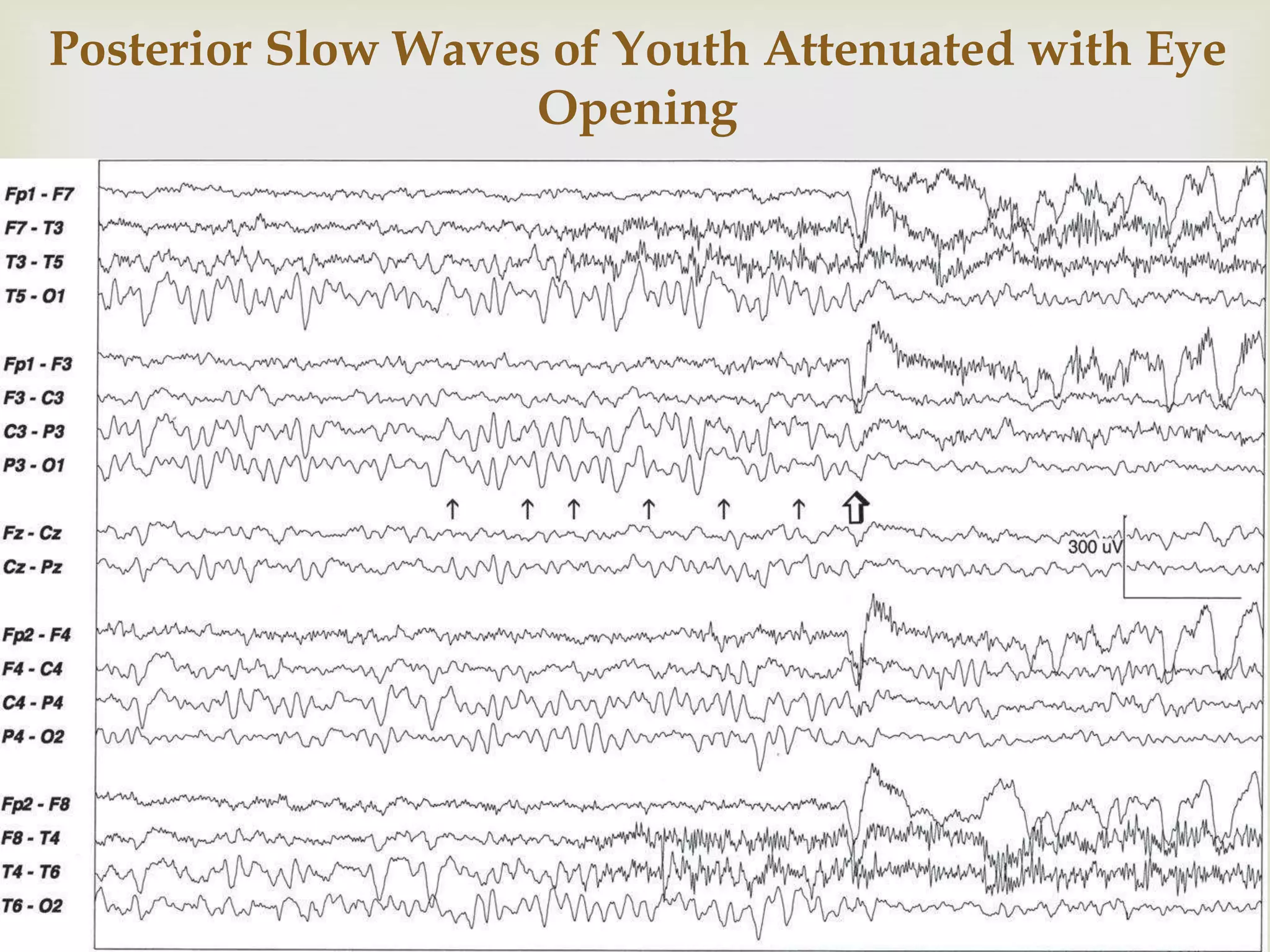 Posterior slow waves of youth | PPTX