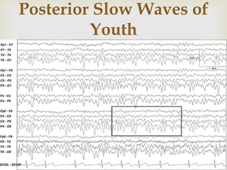 Posterior slow waves of youth | PPTX