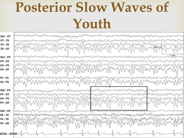 Posterior slow waves of youth | PPTX