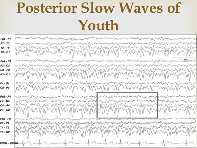Posterior slow waves of youth
