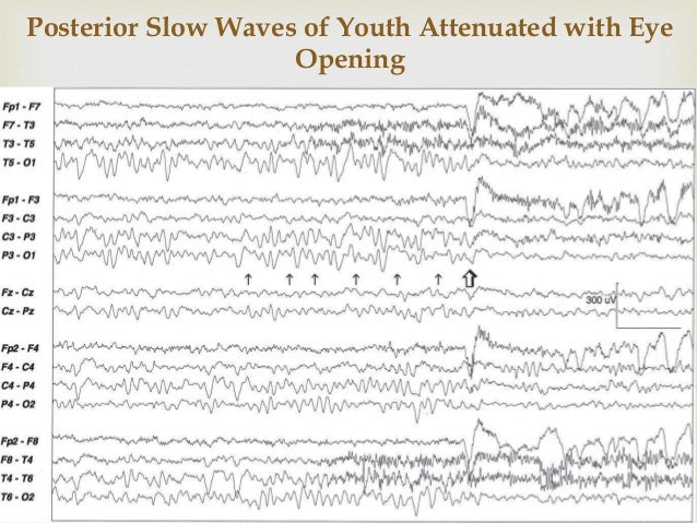 Posterior slow waves of youth