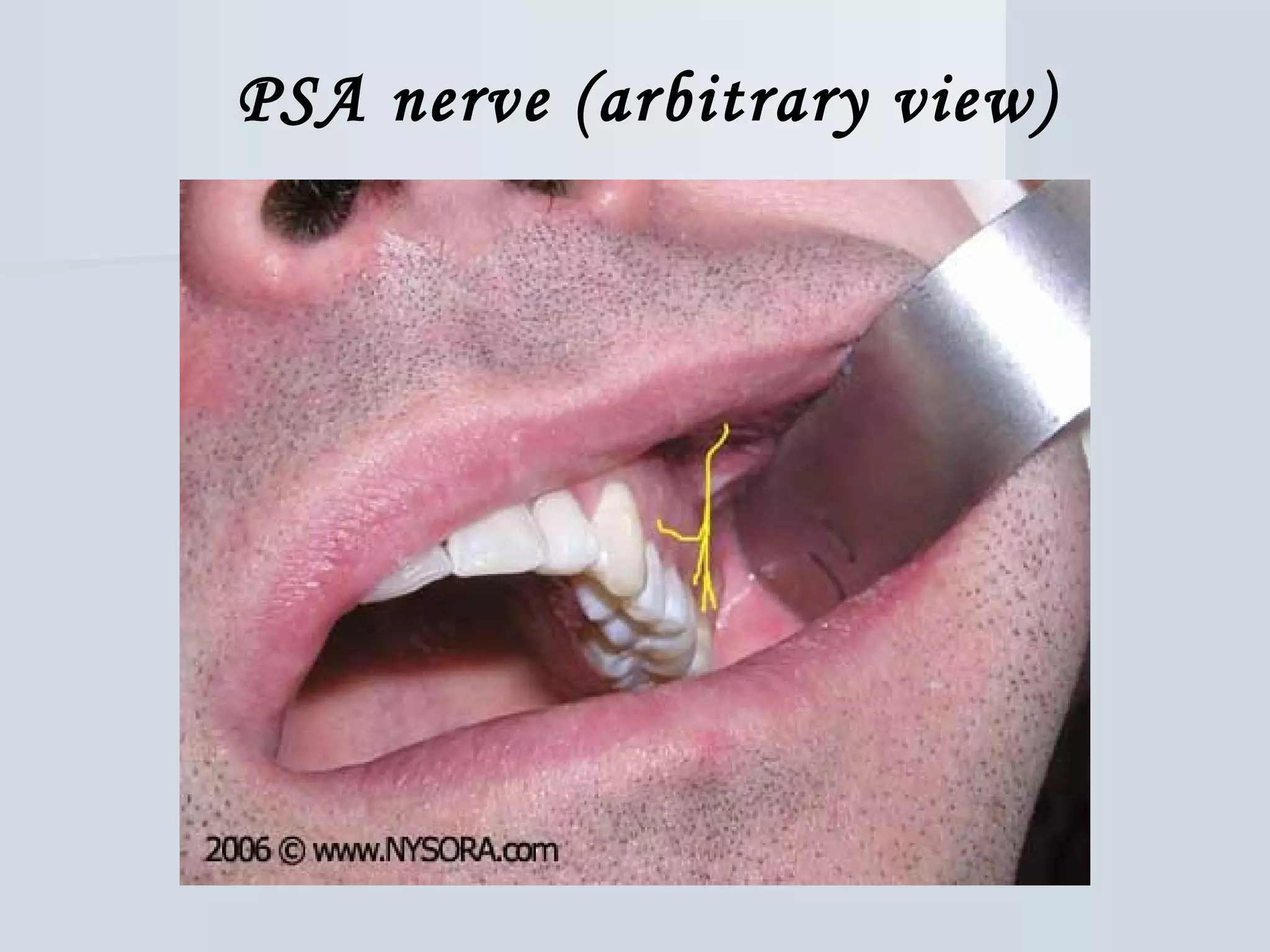 Posterior superior alveolar (psa) nerve block | PPT