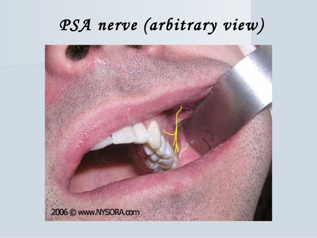 Posterior superior alveolar (psa) nerve block