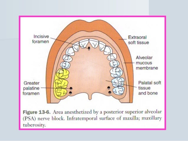 Posterior superior alveolar (psa) nerve block