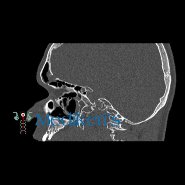 Posterior Table Frontal Sinus Meningoencephalocele | PDF