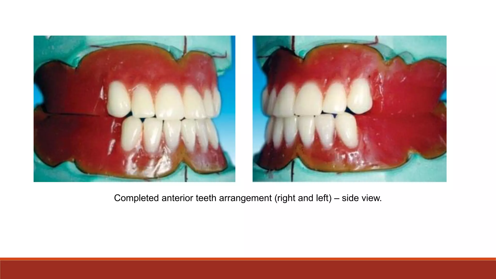 Posterior Teeth Arrangement | PDF