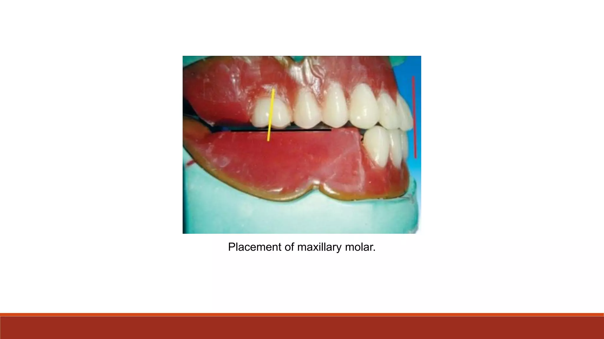 Posterior Teeth Arrangement | PDF