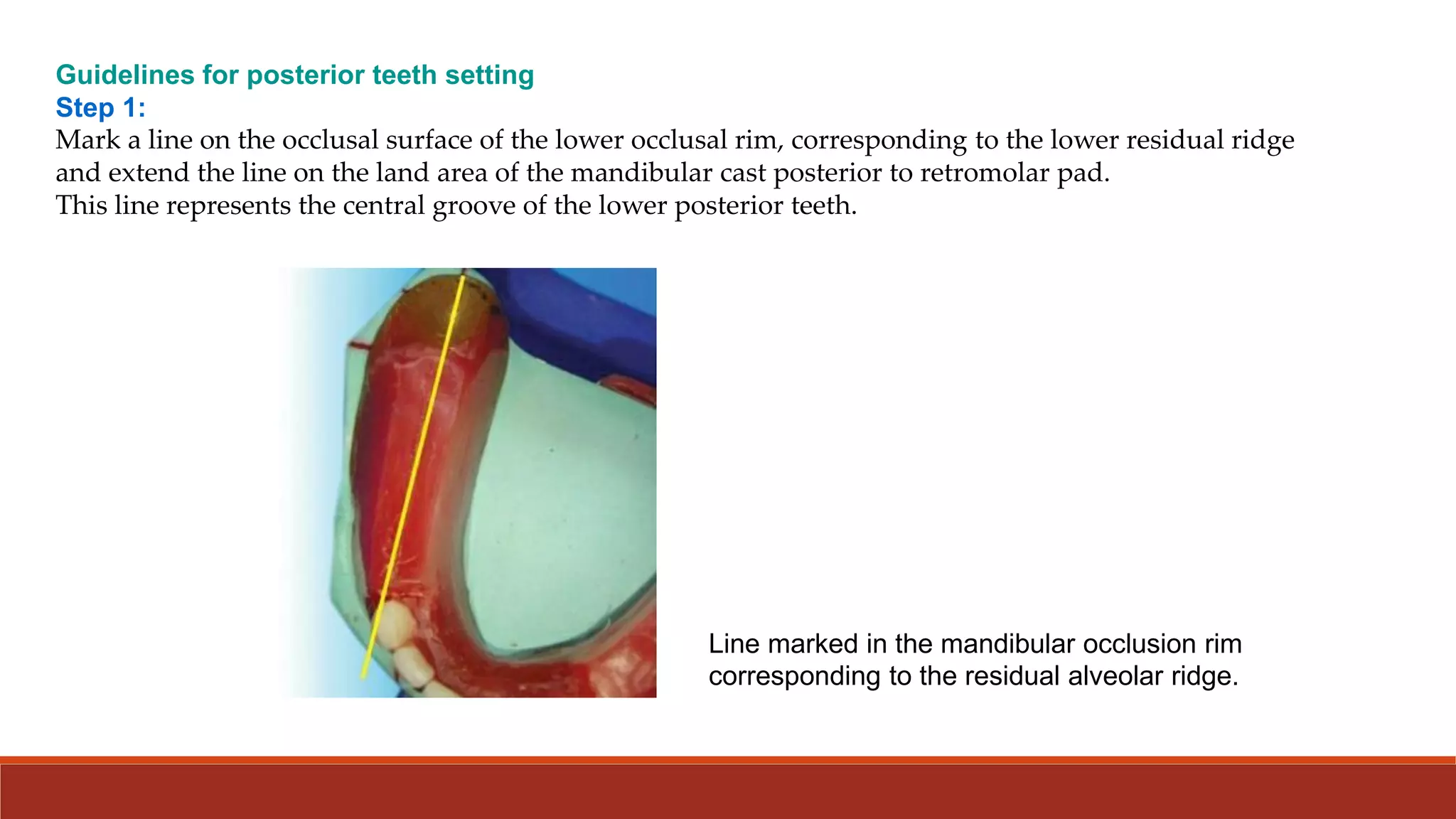 Posterior Teeth Arrangement | PDF