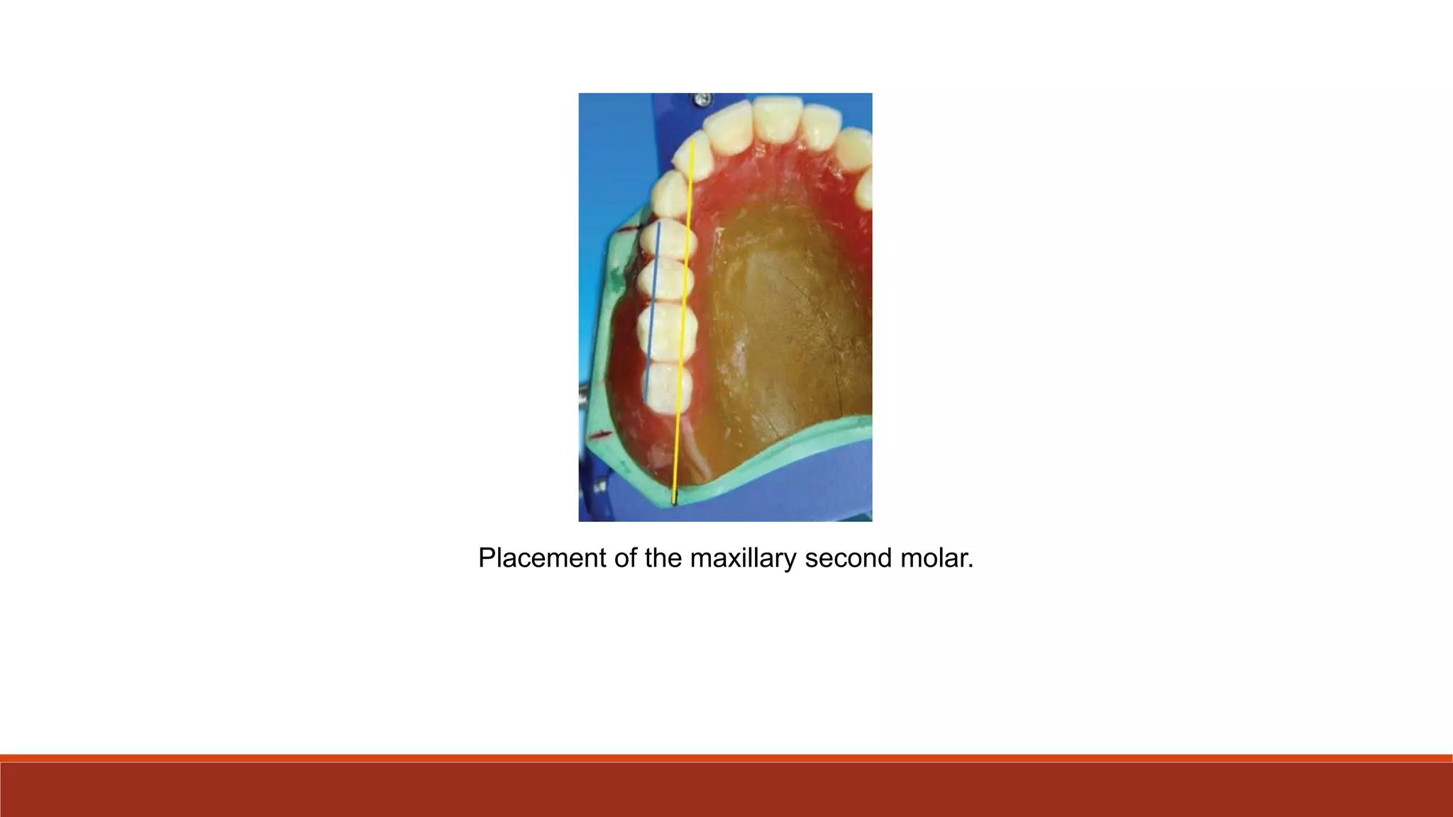 Posterior Teeth Arrangement | PDF