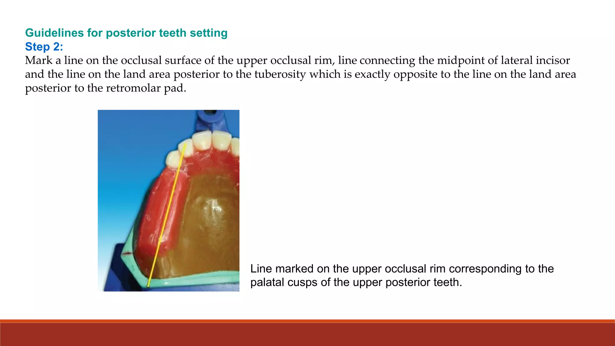 Posterior Teeth Arrangement | PDF