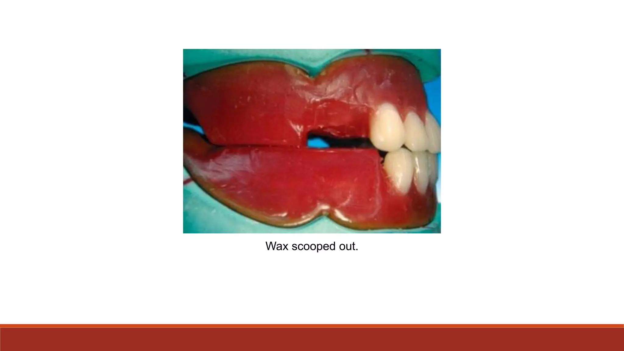 Posterior Teeth Arrangement | PDF