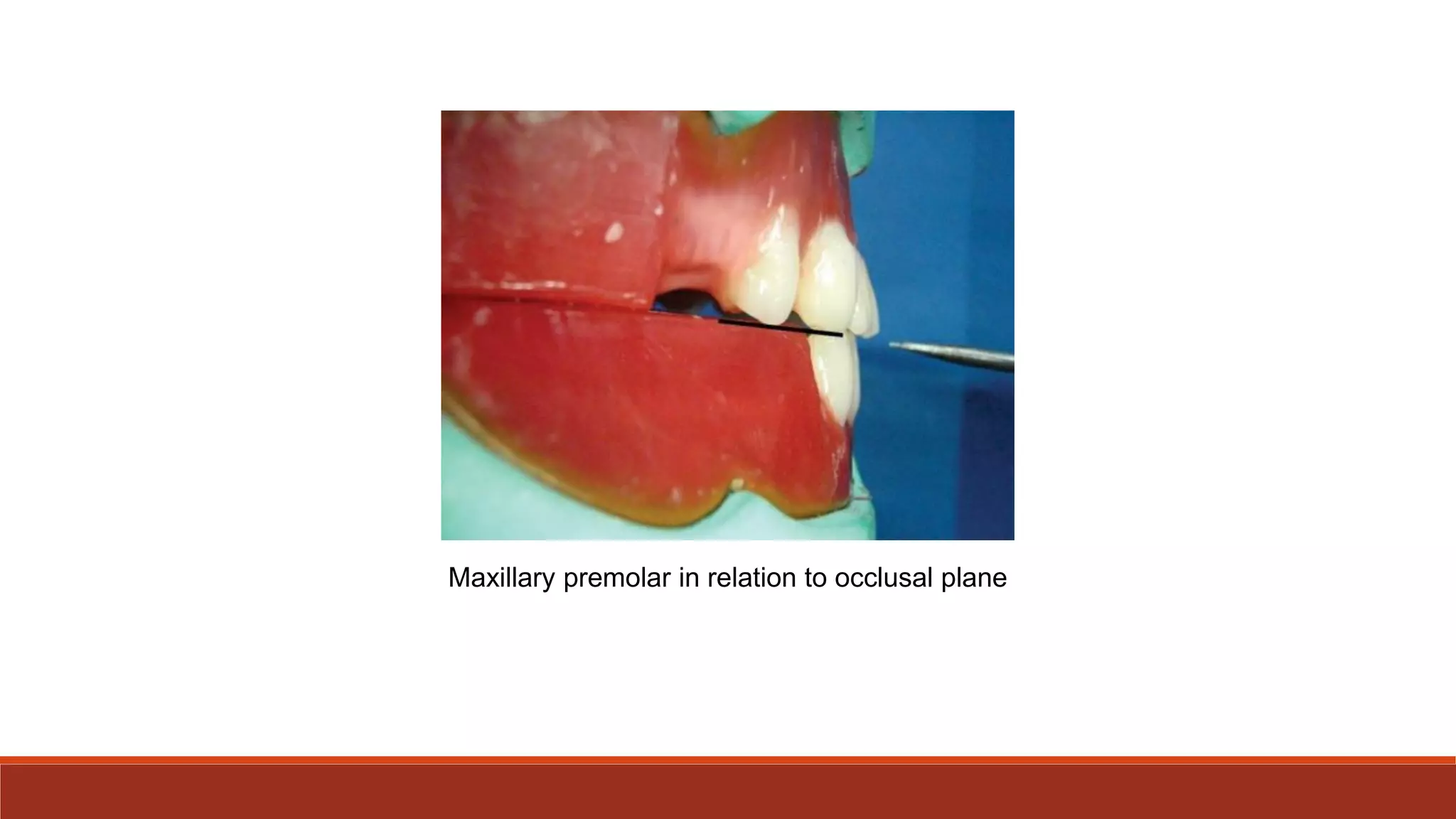 Posterior Teeth Arrangement | PDF