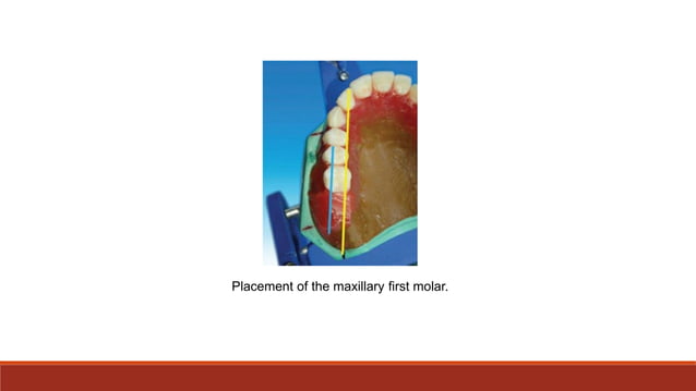 Posterior Teeth Arrangement | PDF