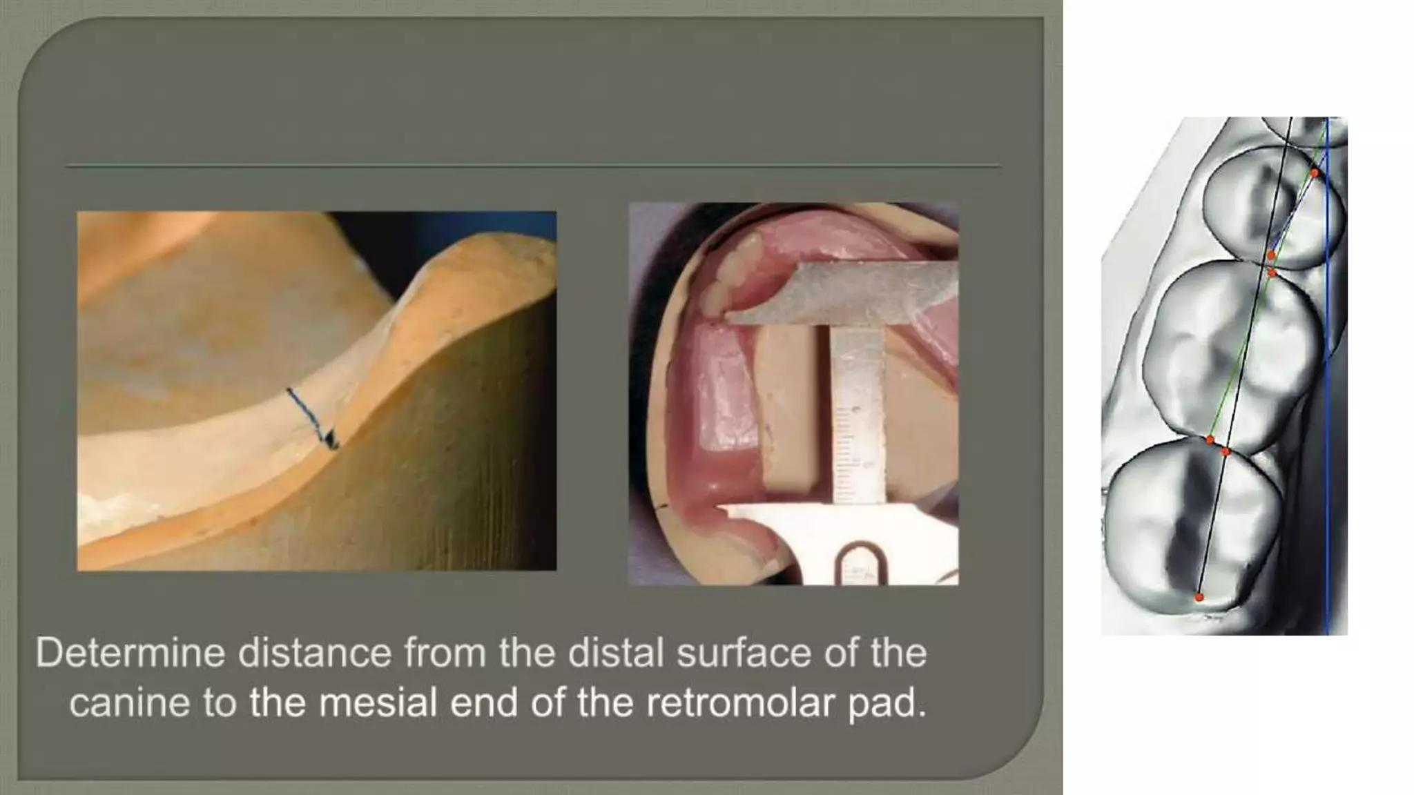 POSTERIOR TEETH SELECTION IN CD.pptx