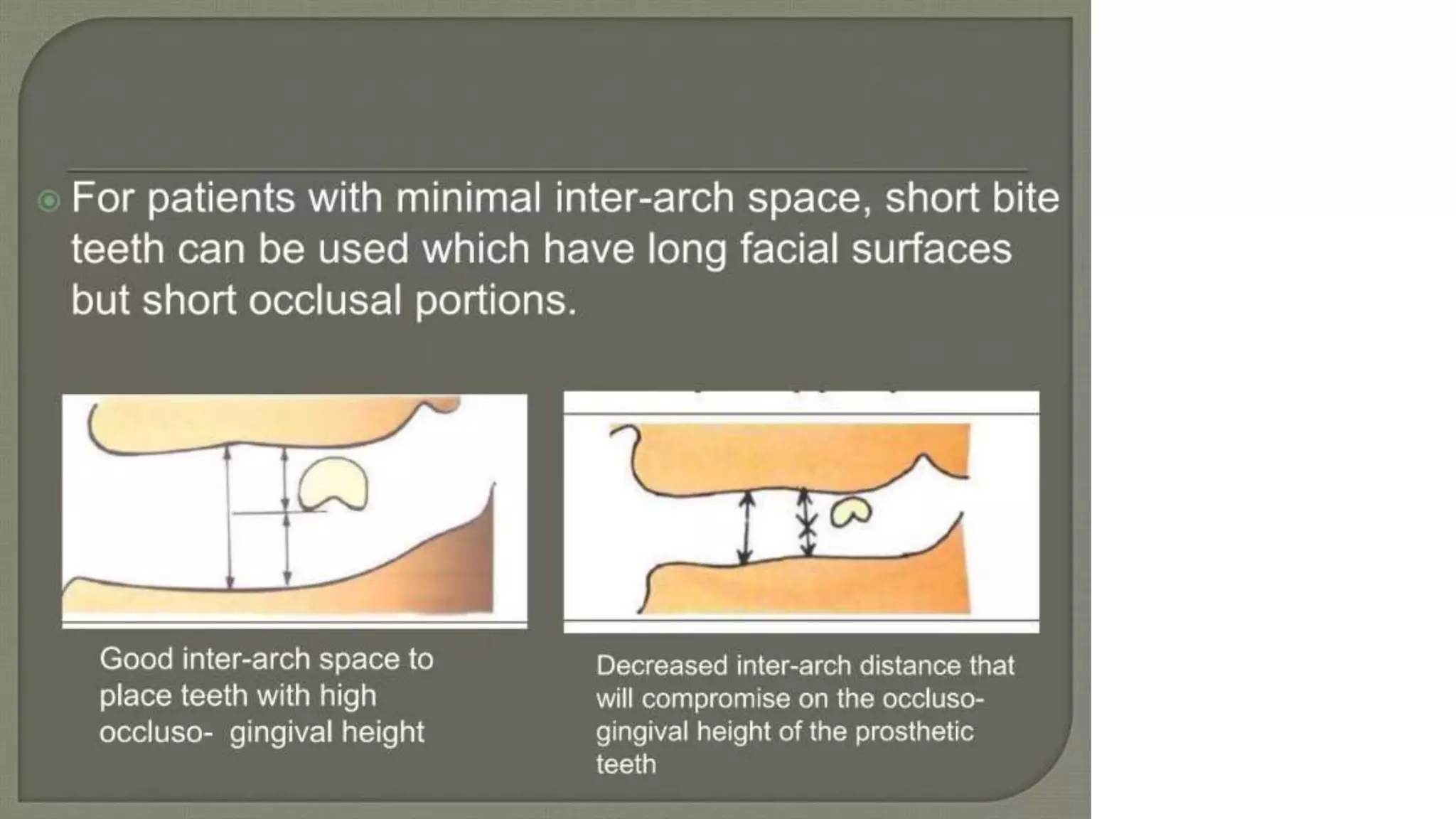 POSTERIOR TEETH SELECTION IN CD.pptx