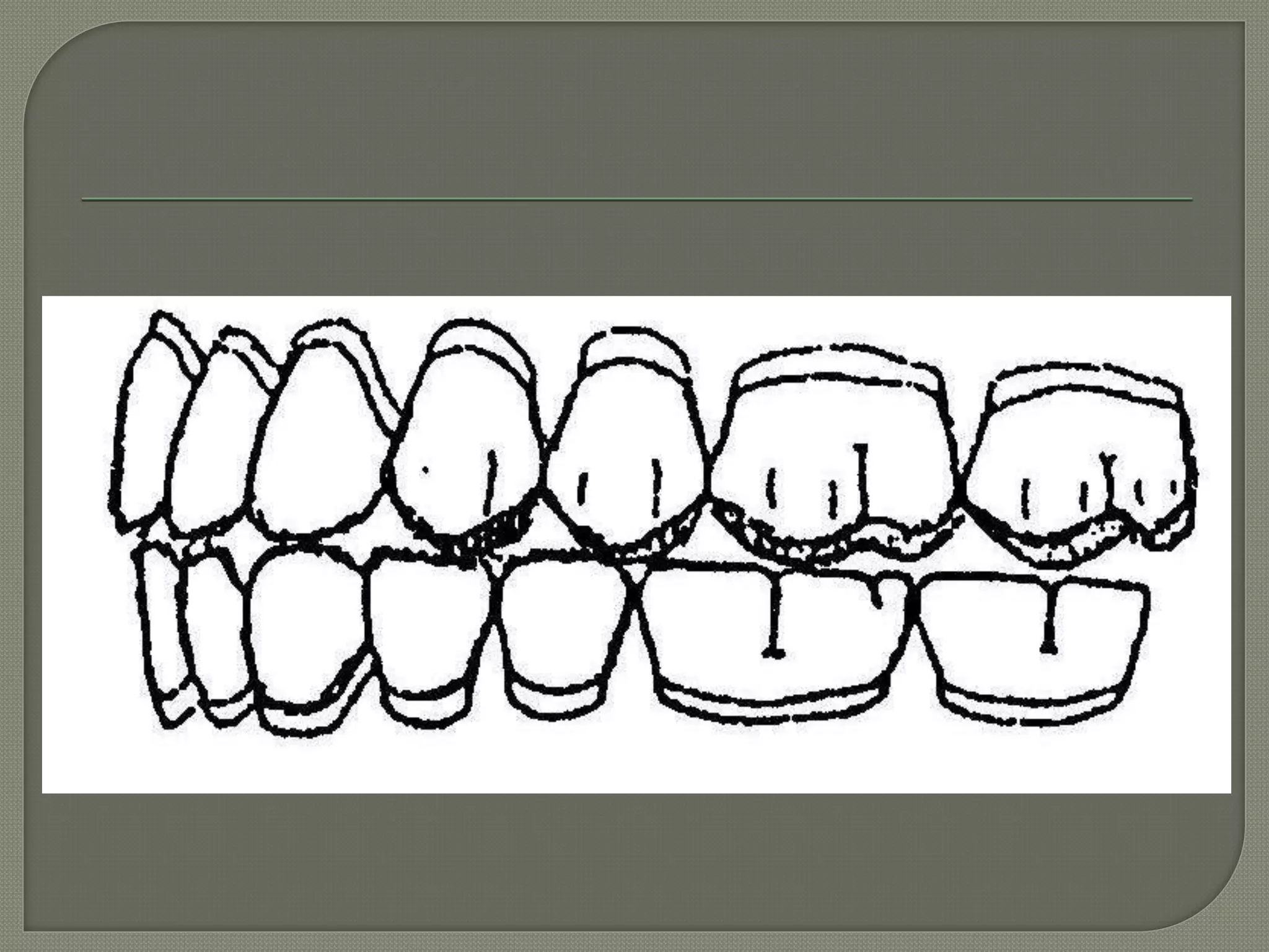 Posterior Teeth Selection in Complete Denture | PPT