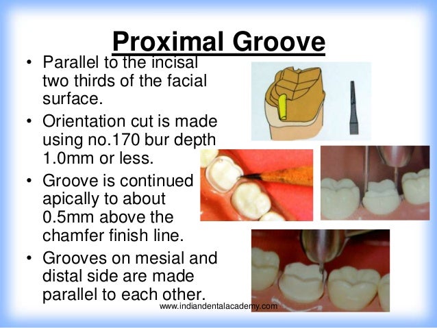 Posterior tooth preparations /certified fixed orthodontic courses by