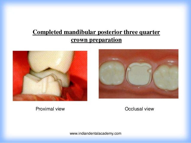 Posterior tooth preparations /certified fixed orthodontic courses by