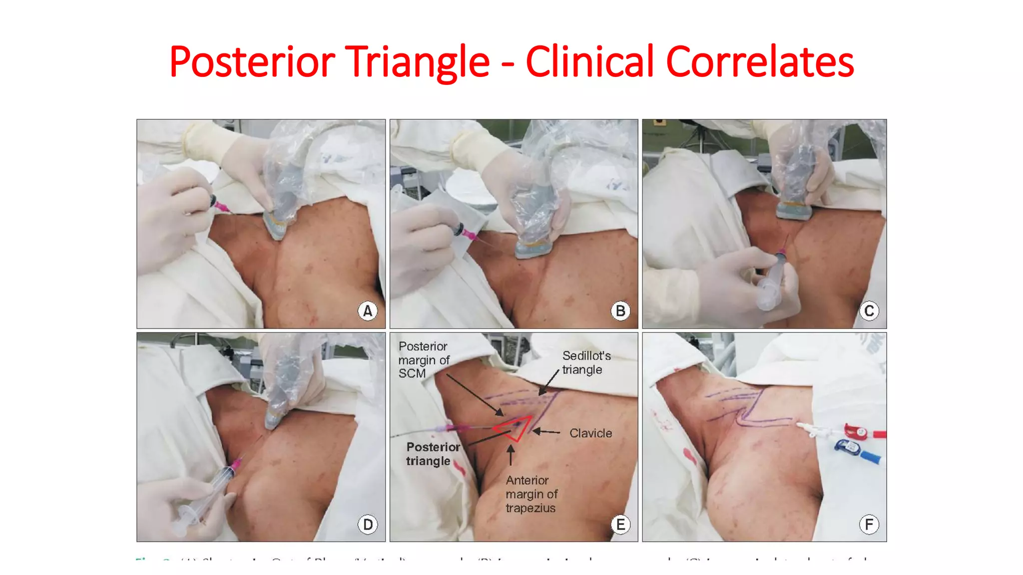 Posterior triangle of neck | PPTX