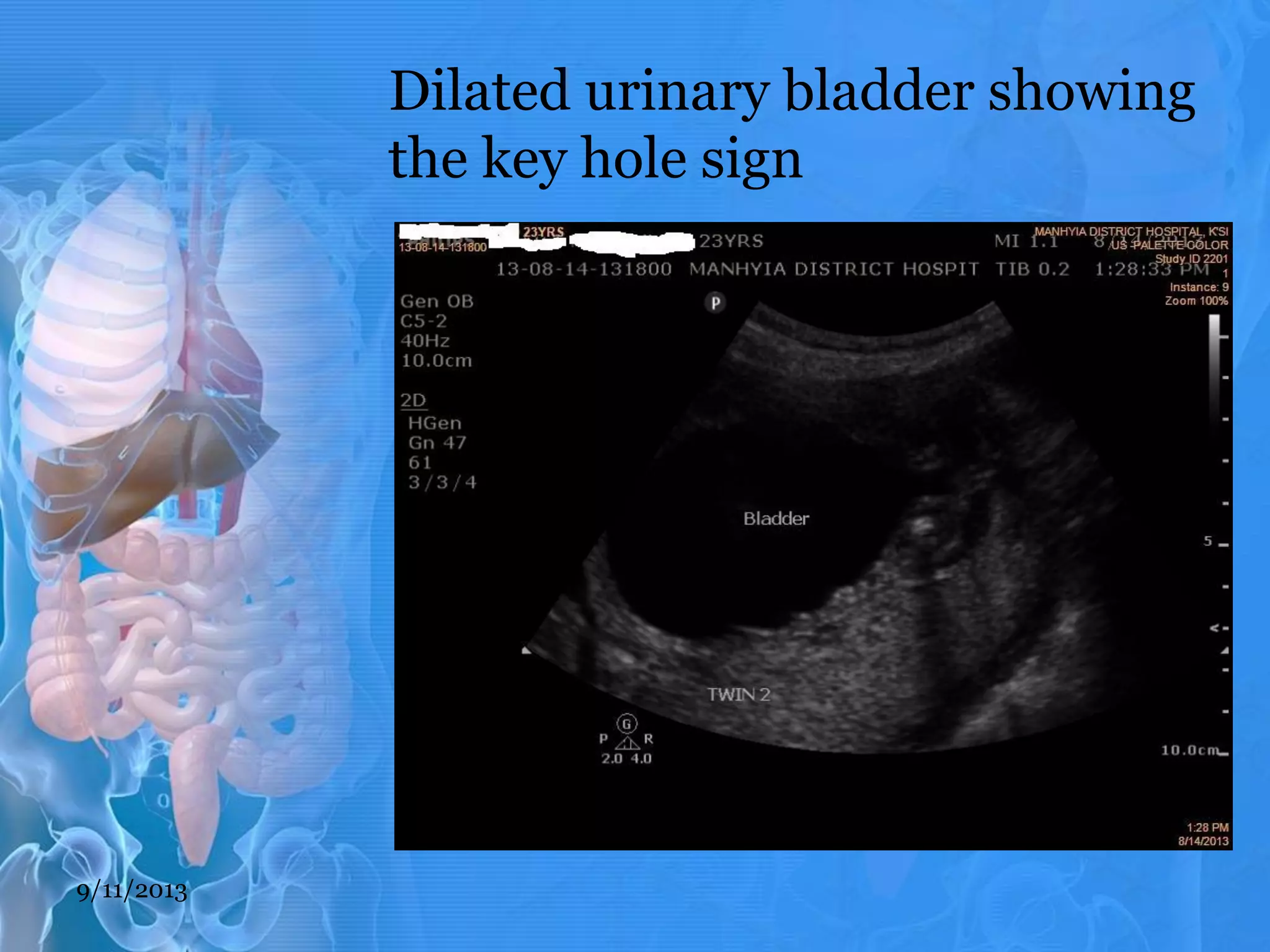 Posterior urethral valve | PPT