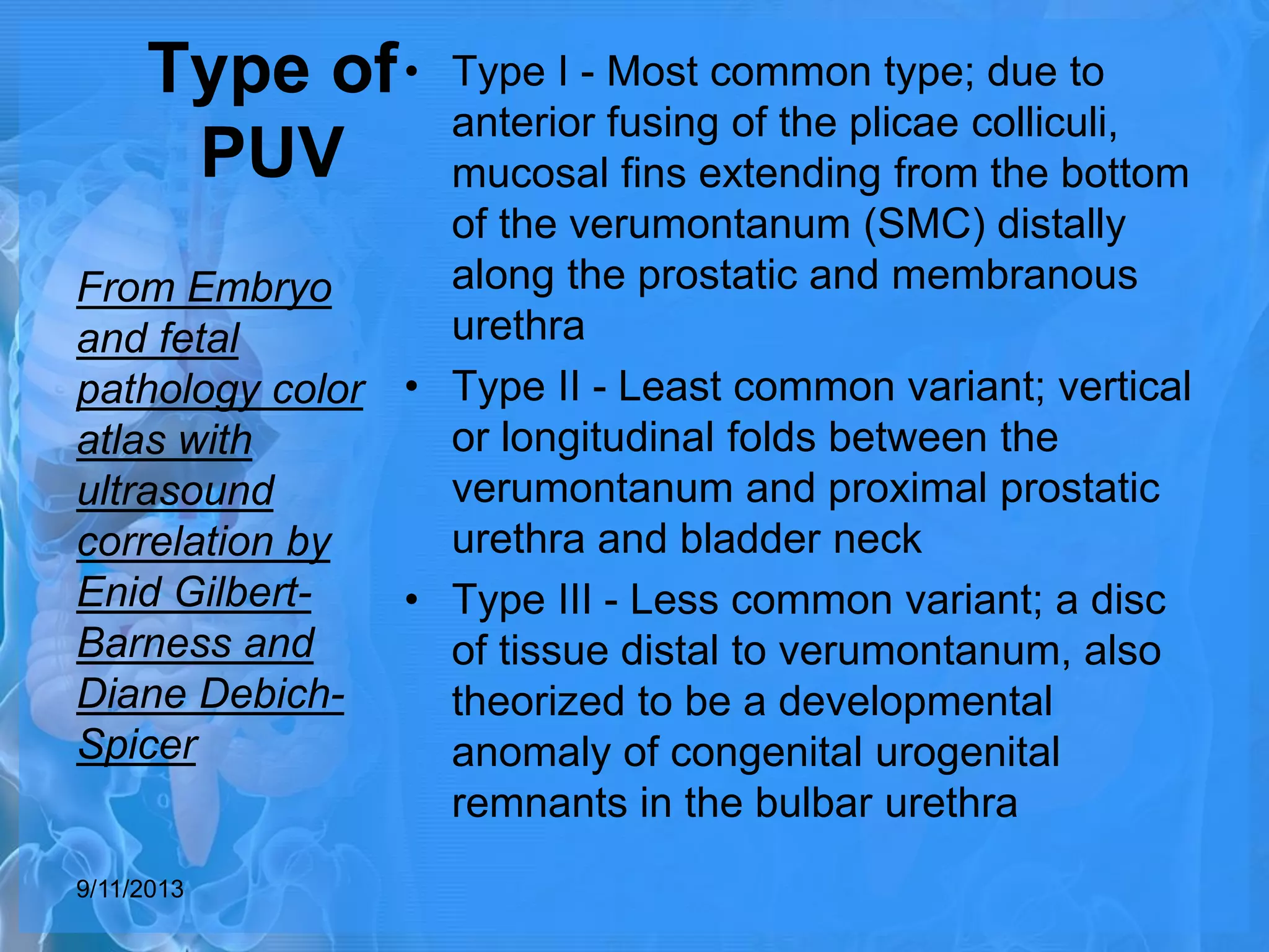 Posterior urethral valve | PPT