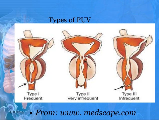 Posterior Urethral Valve posterior-urethral-valve