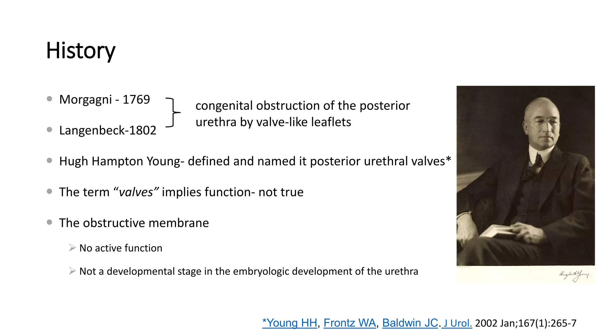 Posterior urethral valve | PPTX
