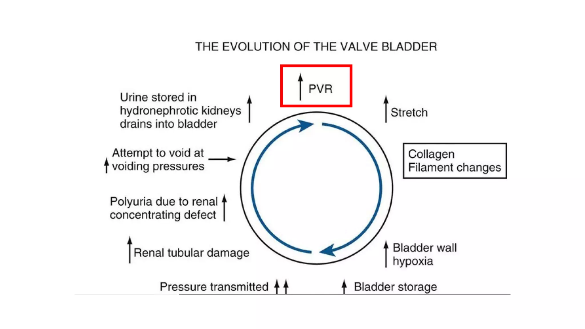 Posterior urethral valve | PPTX