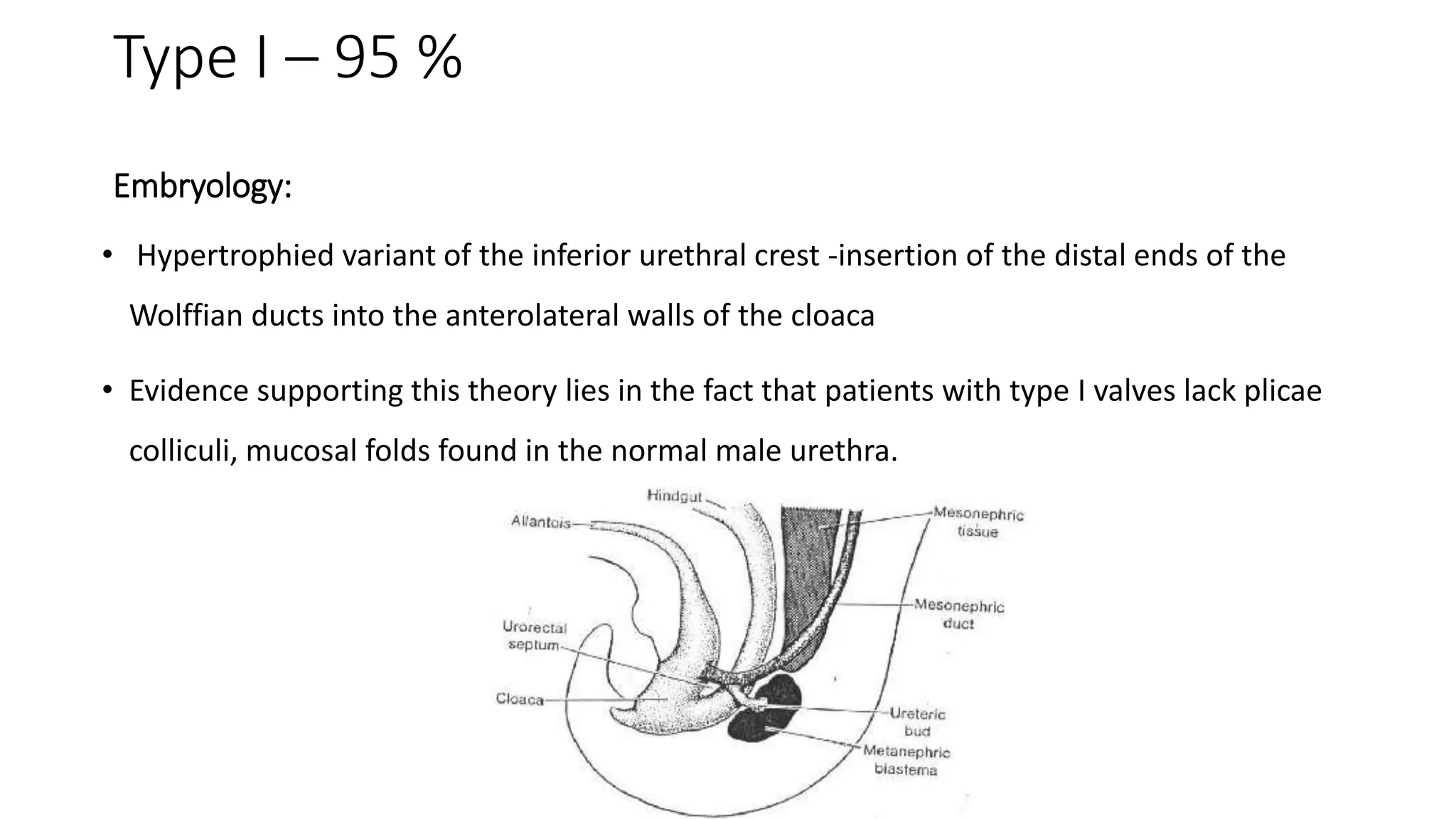 Posterior urethral valve | PPTX