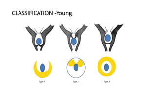 Posterior urethral valve | PPT