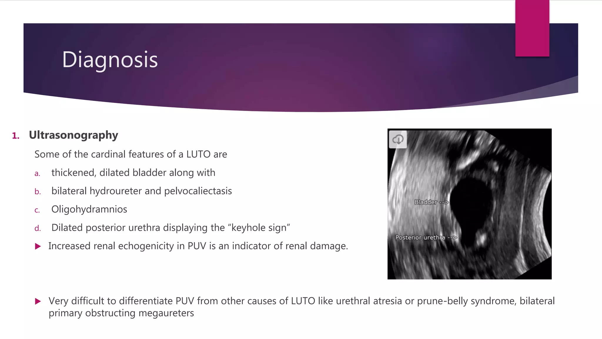 Posterior urethral valve | PPTX