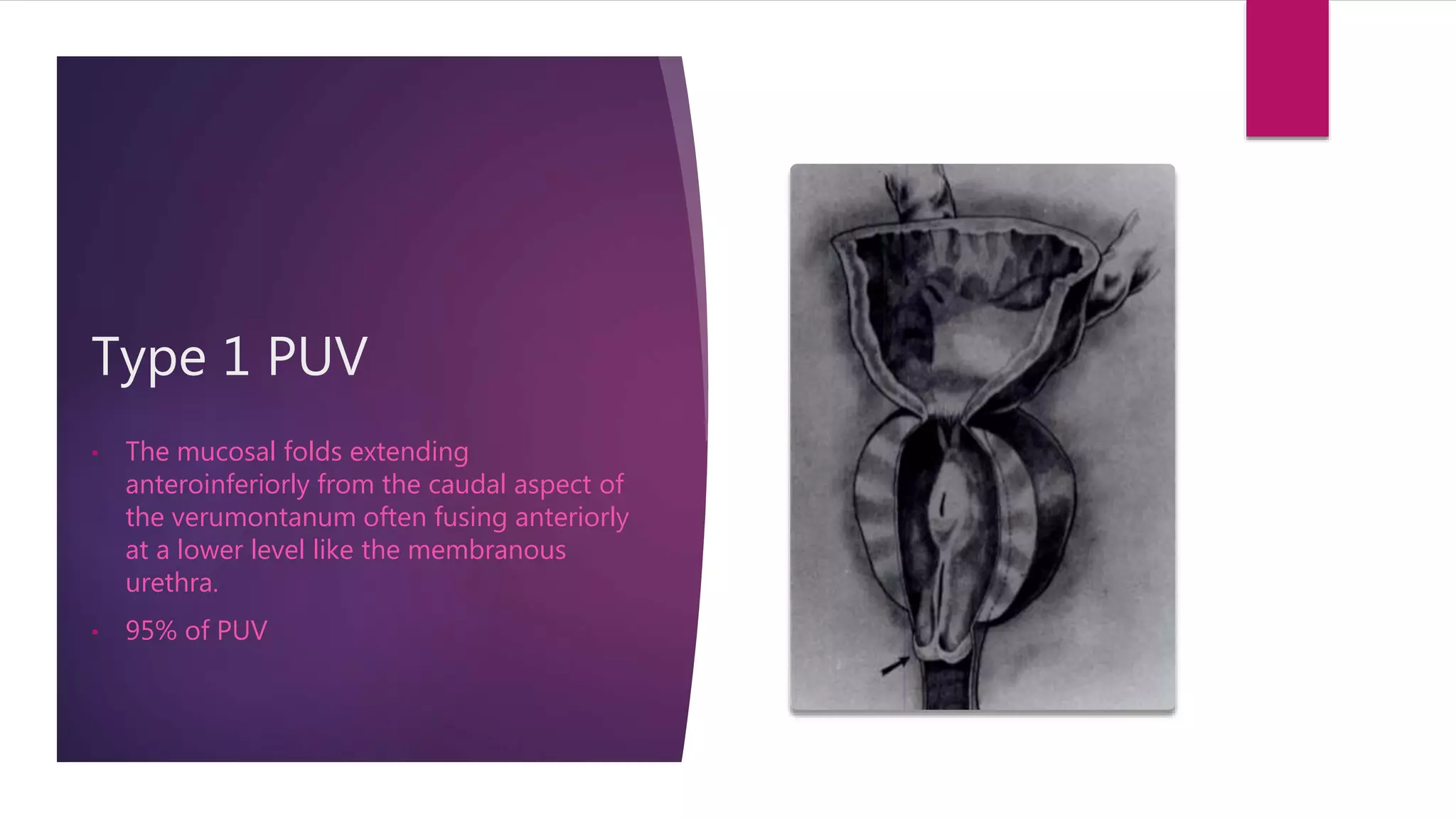 Posterior urethral valve | PPTX