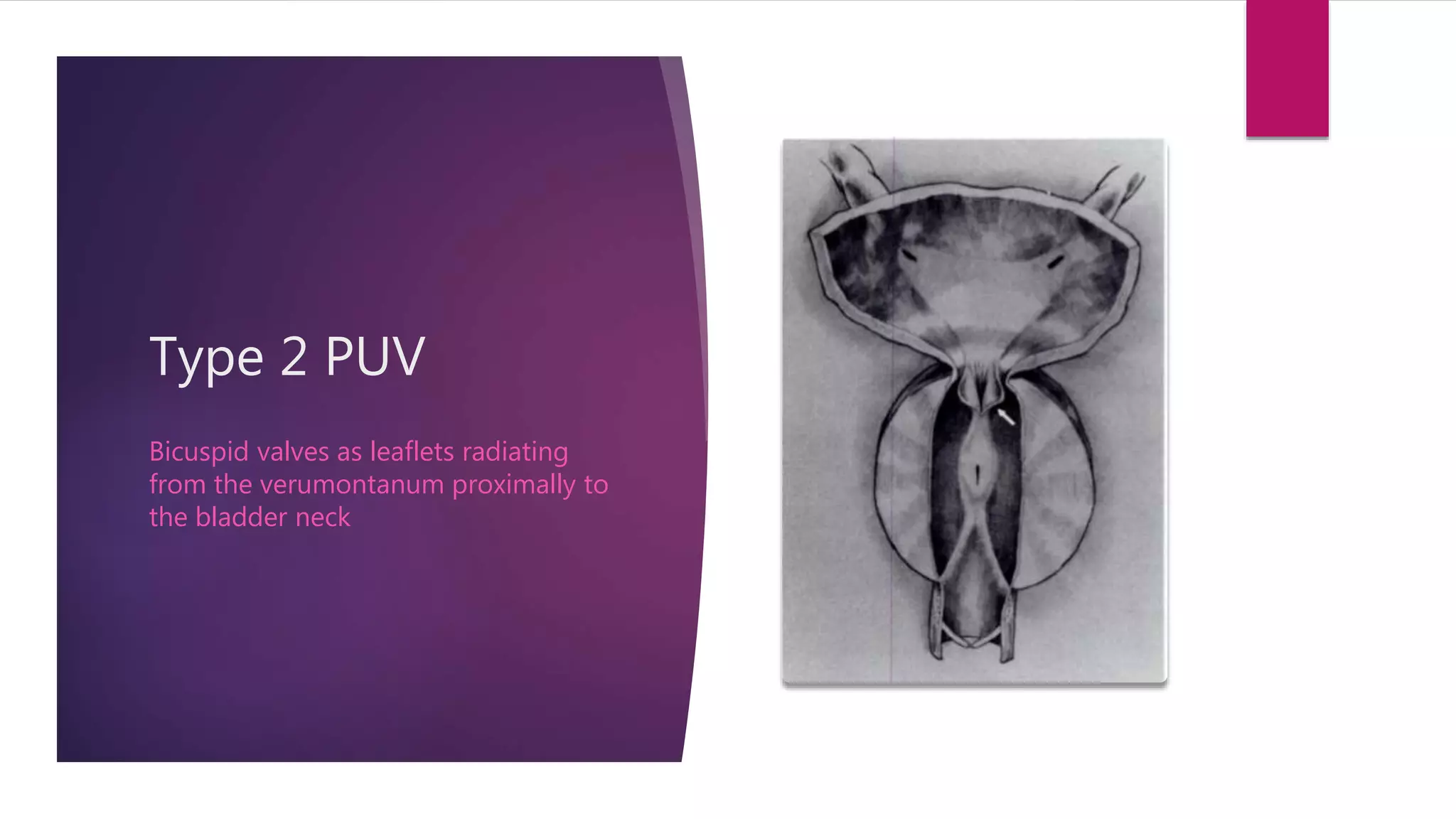 Posterior urethral valve | PPTX