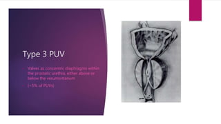 Posterior urethral valve | PPTX