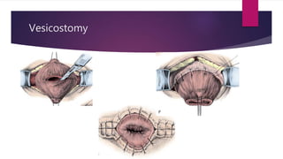 Posterior urethral valve | PPTX