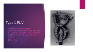 Posterior urethral valve | PPTX