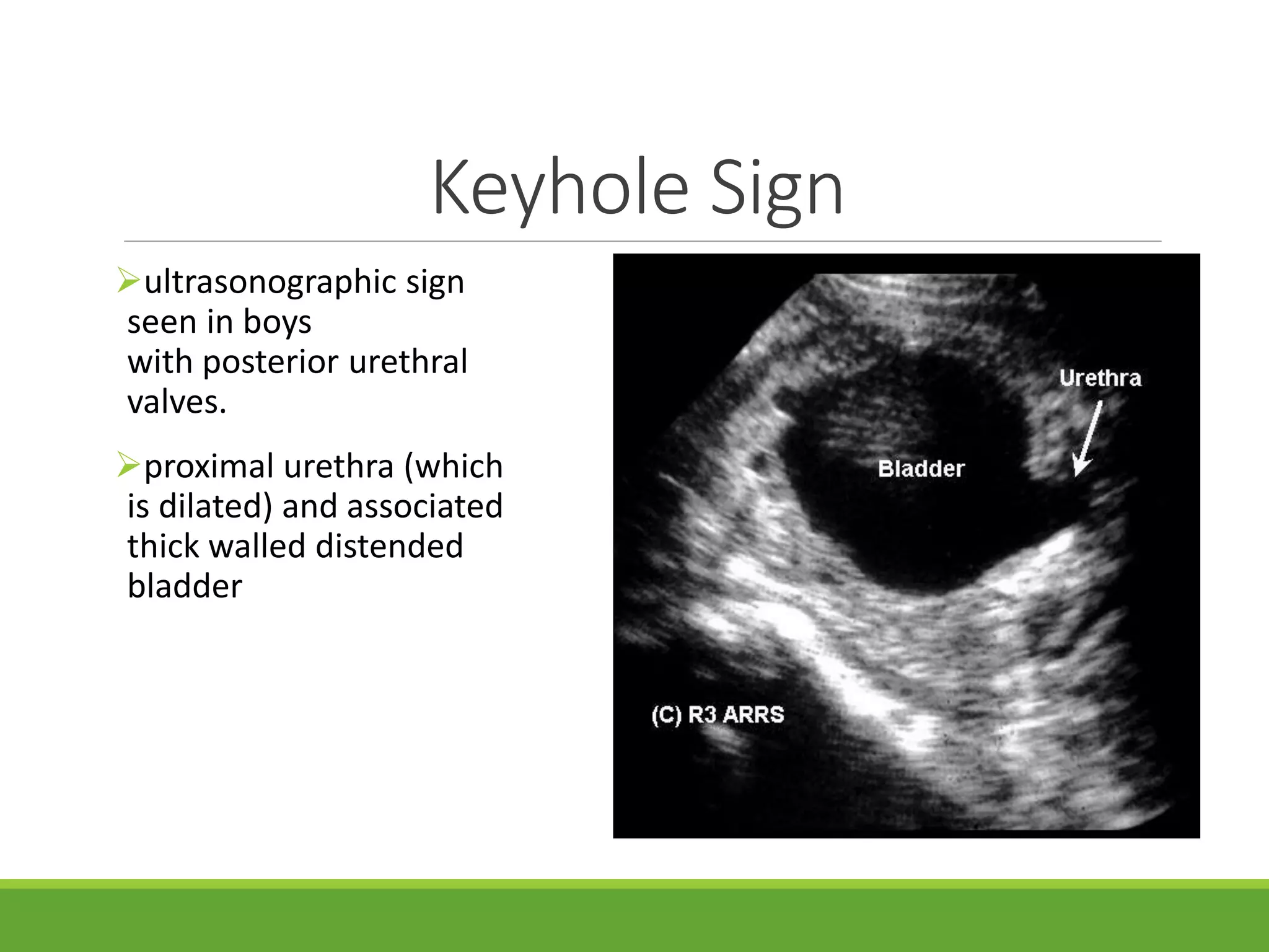 Posterior Urethral Valve | PPTX