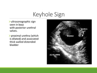 Posterior Urethral Valve | PPTX