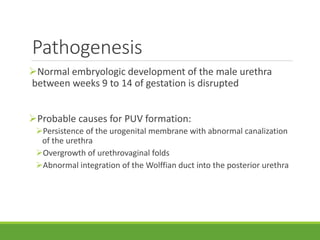 Posterior Urethral Valve | PPTX