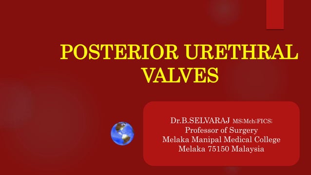 Posterior urethral valves- Pediatric Surgery | PPTX