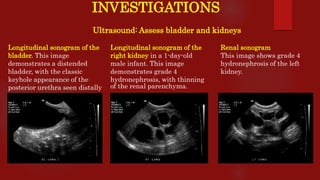 Posterior urethral valves- Pediatric Surgery | PPTX