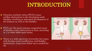 Posterior urethral valves- Pediatric Surgery | PPTX