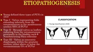 Posterior urethral valves- Pediatric Surgery | PPTX